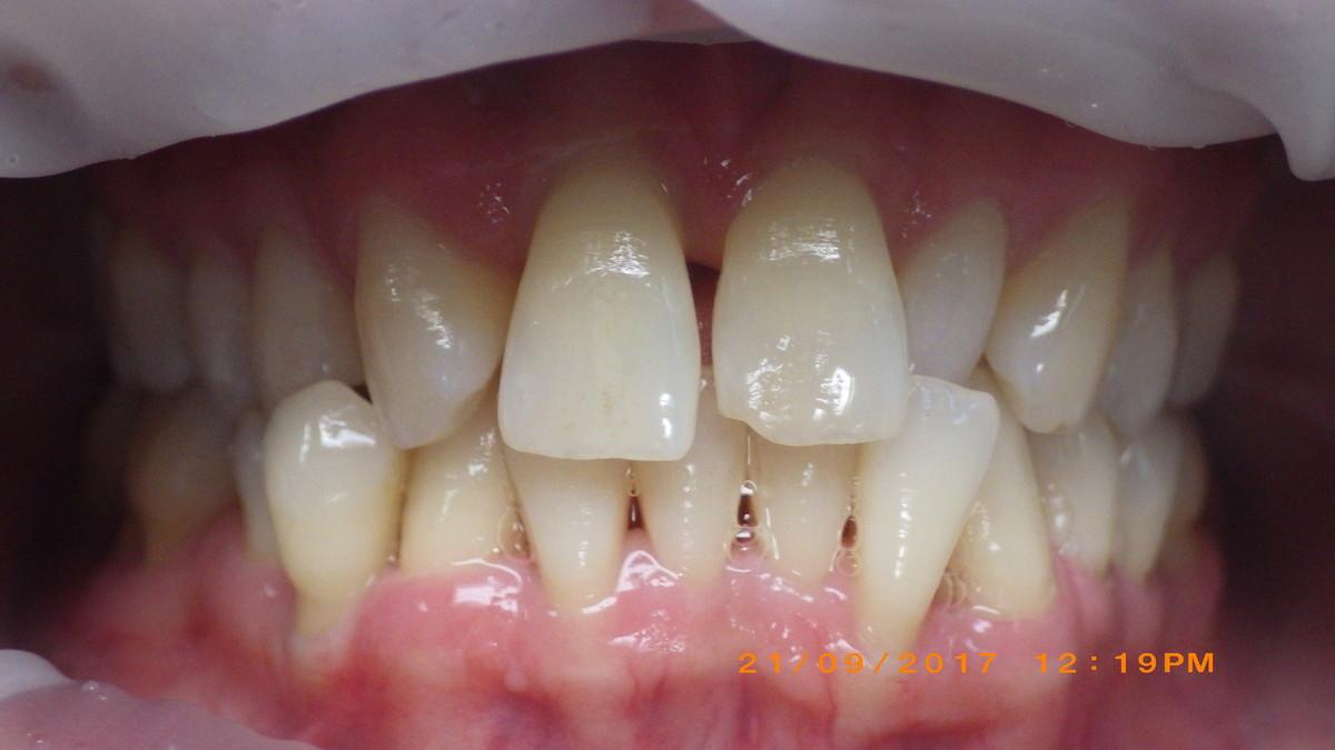 Fastbraces® | Capital Dental